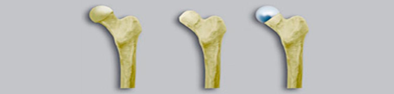 Hip Resurfacing Surgery | Arthroplasty | Total Hip Arthroplasty | AIOR